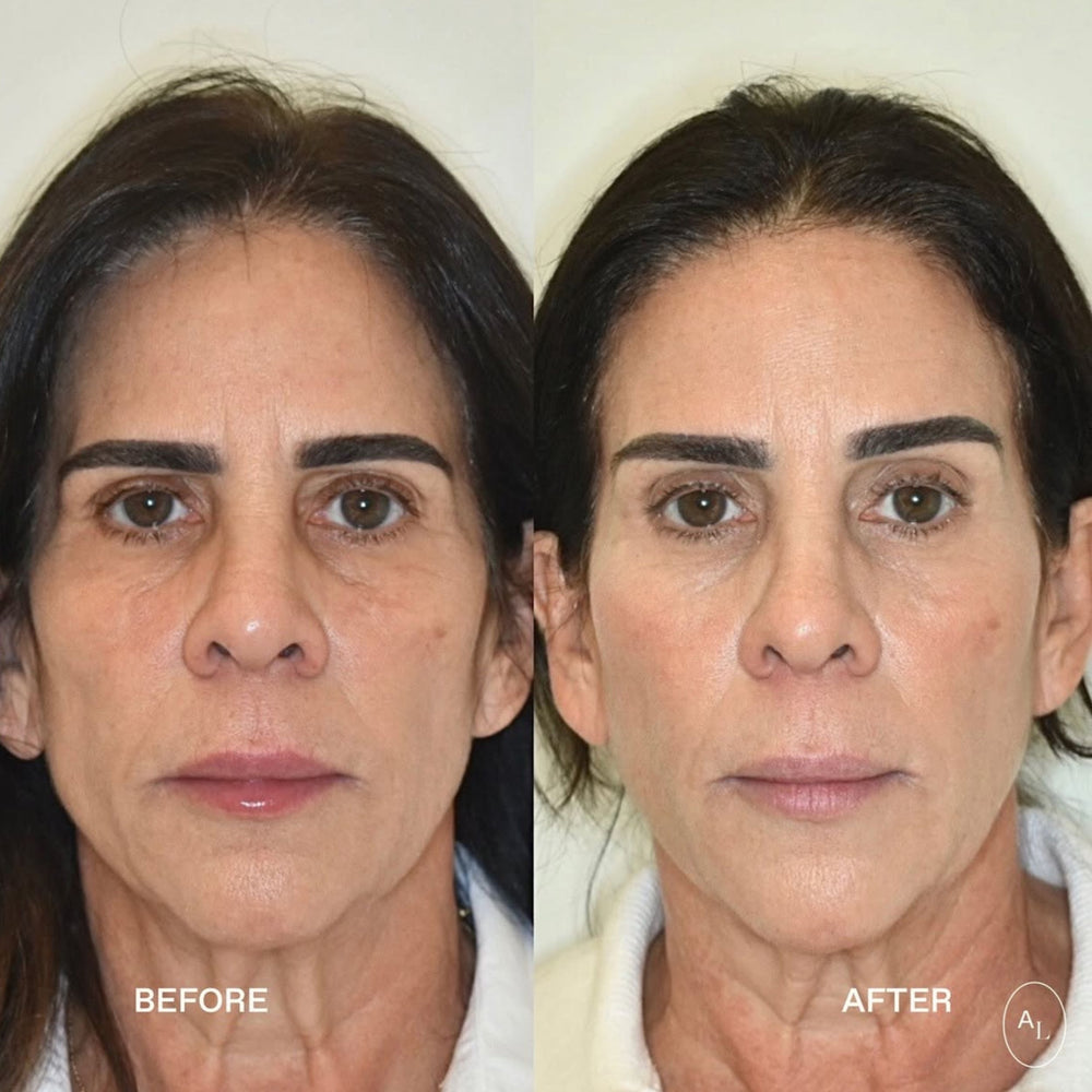 Sculptra Miami | Alexis Lauren – Alexis Lauren